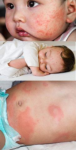 Dermatologia pedriatrica CLINICA DERMALASER EJIDO ALMERIA